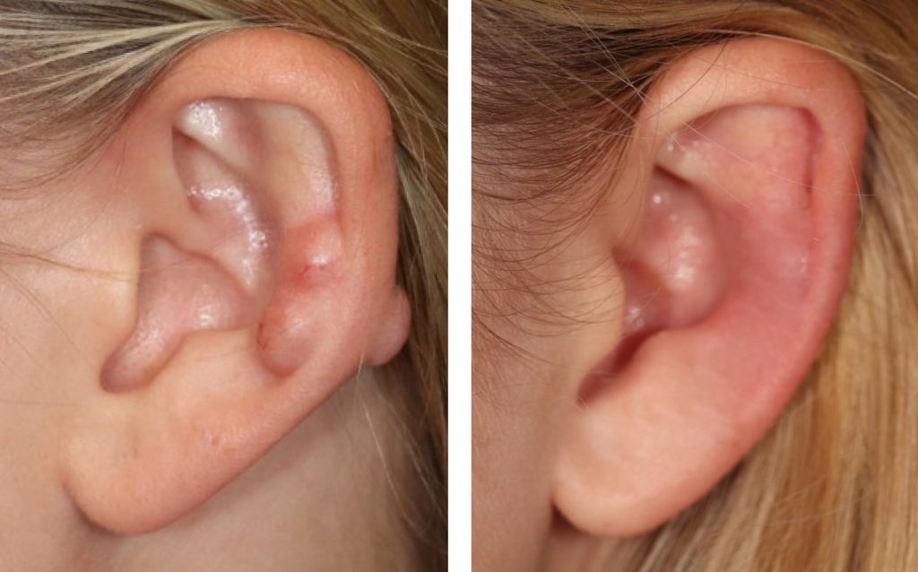 Management Of Keloid Scars Caused By Ear Piercings Appearance Center Management Of Keloid Scars Caused By Ear Piercings Appearance Center