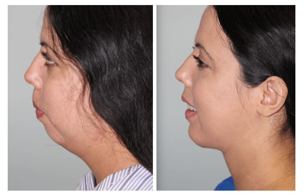What is a Chin Implant? - Appearance Center of Newport Beach
