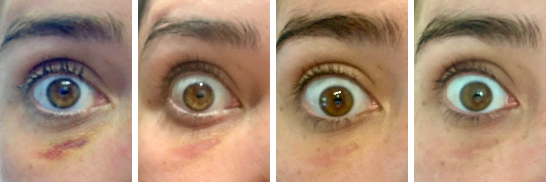 Minimizing and Treating Bruising after Procedures | Appearance Center ...