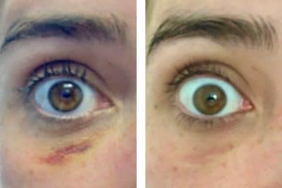 Minimizing and Treating Bruising after Procedures - Appearance Center ...