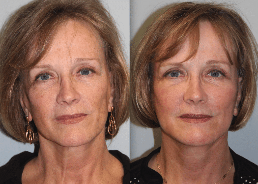 Facial Filler vs. Fat Grafting - Appearance Center of Newport Beach